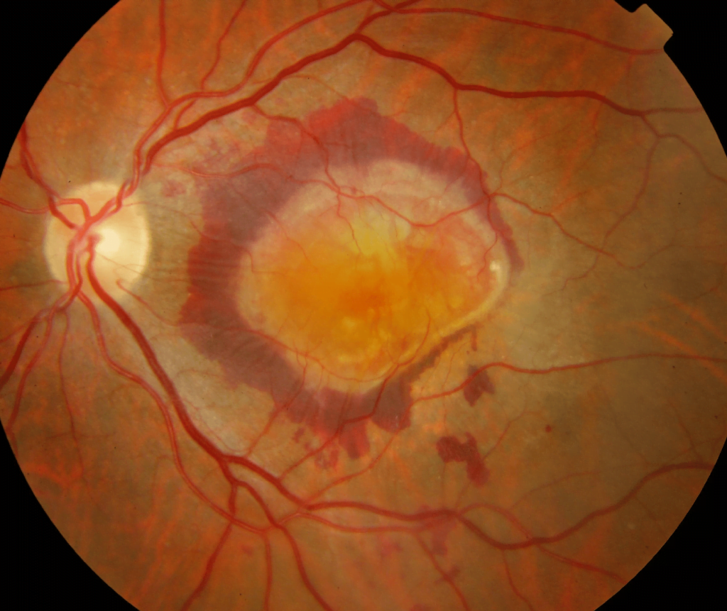 Vidéo les signes d'une DMLA - Annecy Ophtalmo