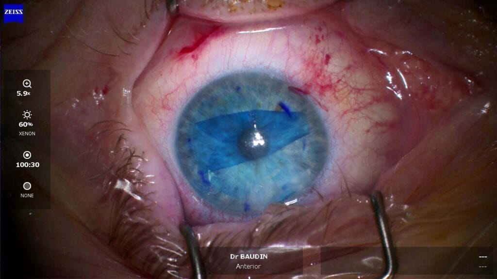 Traitement de la cornea guttata: DMEK vs DSAEK & greffe transfixiante ...
