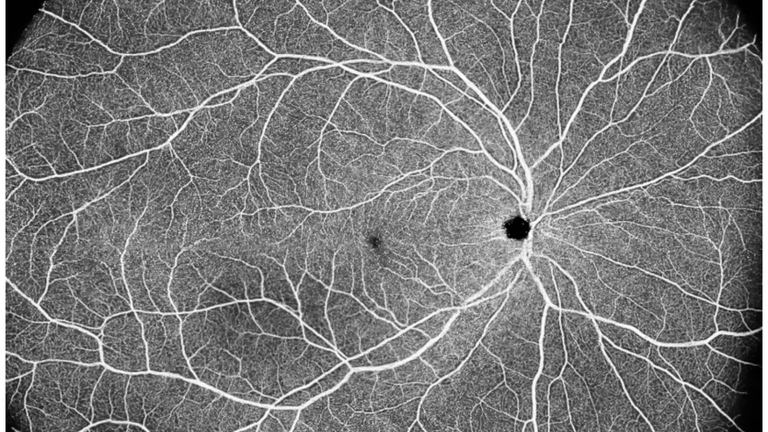 La Rétine - Annecy Ophtalmo