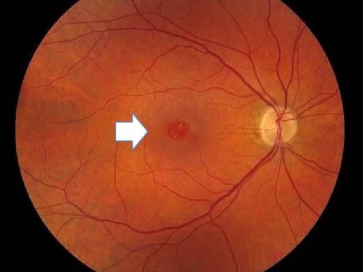 Pathologies rétiniennes - Annecy Ophtalmo